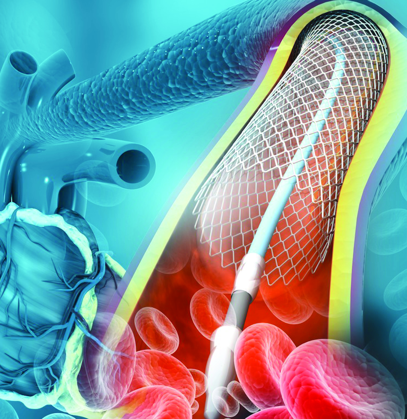 Cardiac Stents and Catheters Manufacturing Plant Project – Kingdom of ...